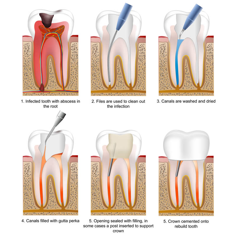 Root Canal Treatment Tunbridge Wells Bower Dental Practice Root Canal Treatment Tunbridge Wells Bower Dental Practice
